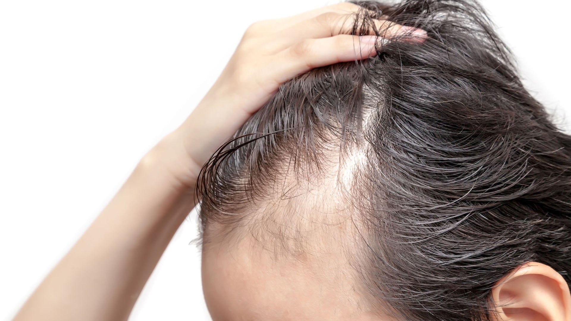 10 Non-Invasive Ways to Fix a Receding Hairline – Hairmax