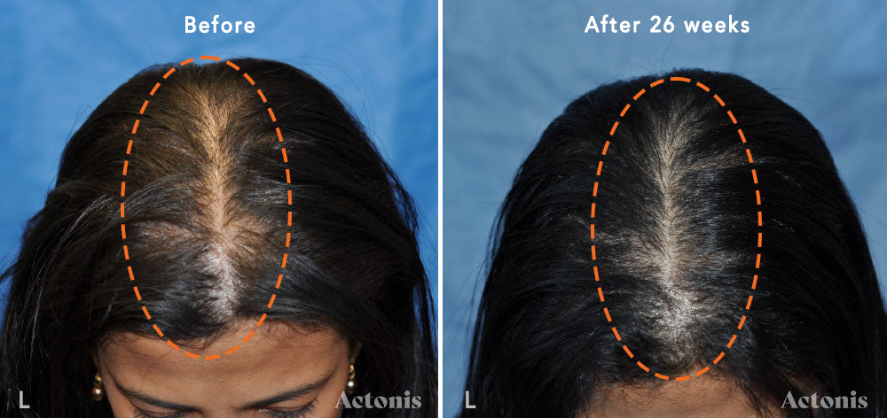 Actonis™ 18 Dual Action LaserComb – Hairmax