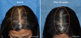 Actonis™ 18 Dual Action LaserComb – Hairmax