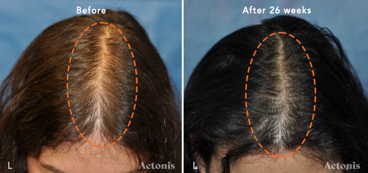 Actonis™ 18 Dual Action LaserComb – Hairmax