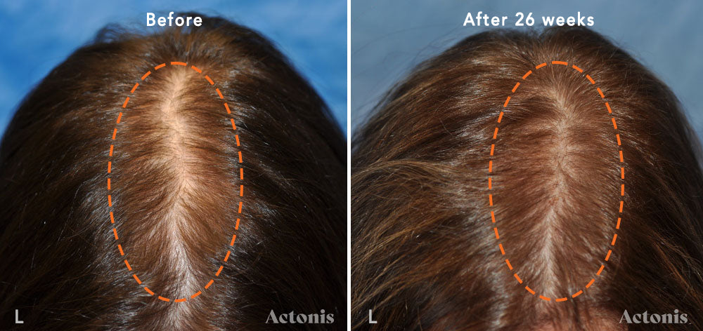 Actonis Complete Hair Growth Essential Bundle – Hairmax