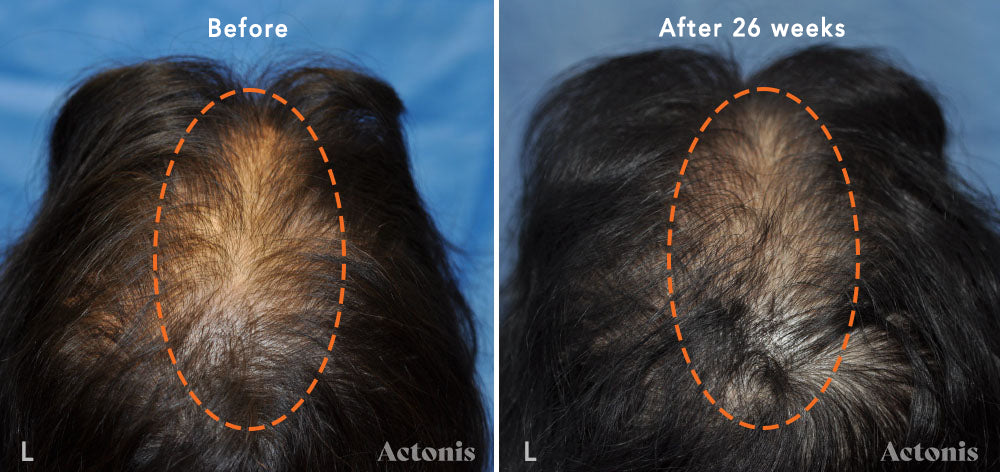 Actonis Complete Hair Growth Essential Bundle – Hairmax