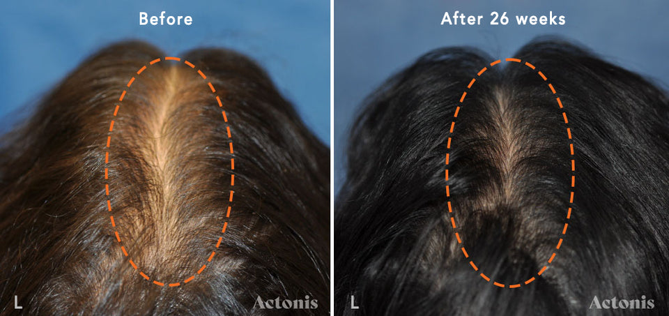 Actonis™ 18 Dual Action LaserComb – Hairmax