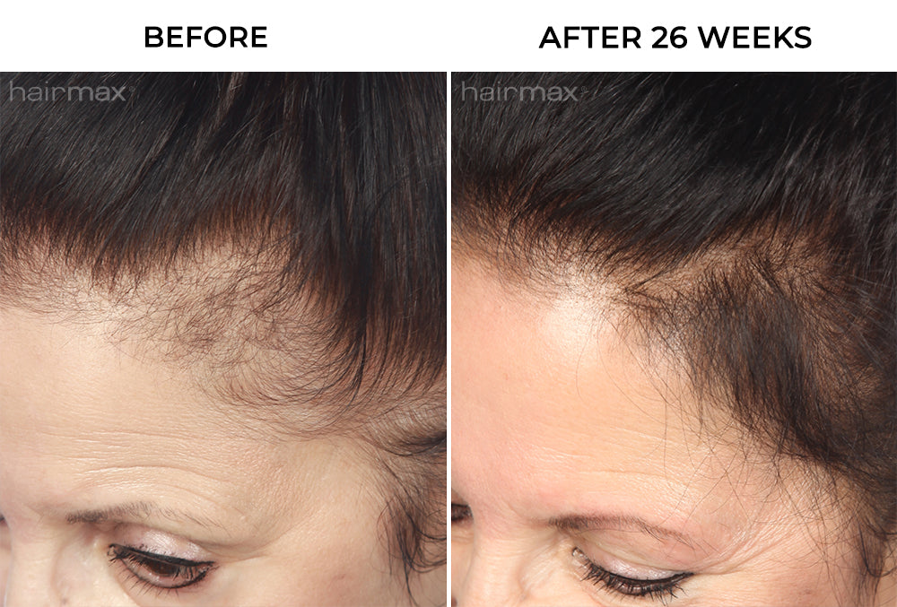 Hairmax® Ultima 12 LaserComb