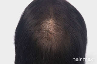 Hairmax® | Hair Regrowth Laser Treatments for Hair Loss