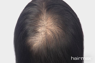 Hairmax® | Hair Regrowth Laser Treatments for Hair Loss