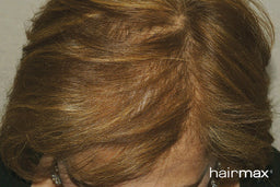 Hairmax® | Hair Regrowth Laser Treatments for Hair Loss