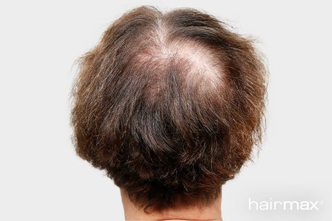 Hairmax® | Hair Regrowth Laser Treatments for Hair Loss